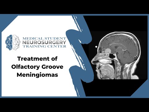 Treatment of Olfactory Groove Meningiomas