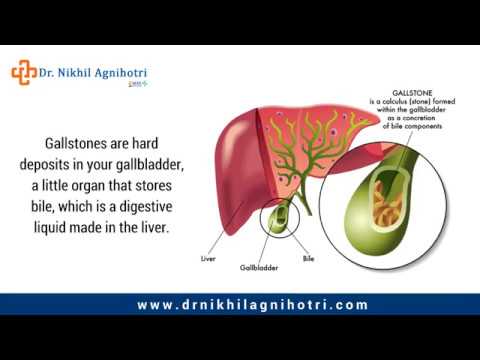 Gallbladder Stones Treatment Service Provider from New Delhi