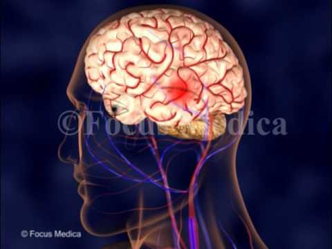 Cerebral angiography - Neuroanatomy
