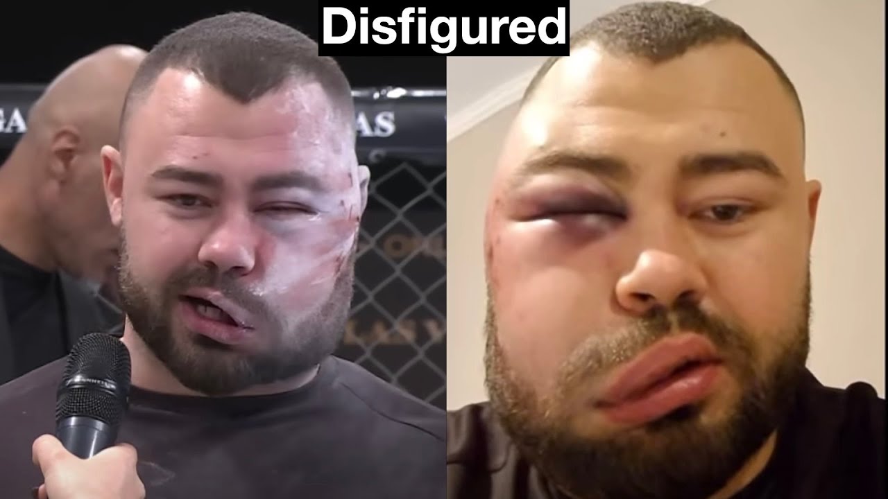 Disfigured, Mutilated and Dead | The Turbulent History of Slap Fighting ...