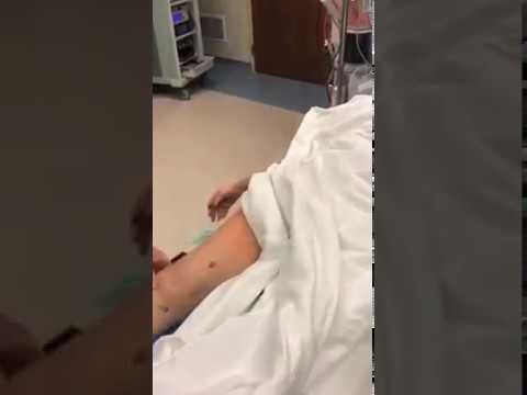 Manipulation Under Anesthesia VIDEO - KRYSTAL (33 years old)