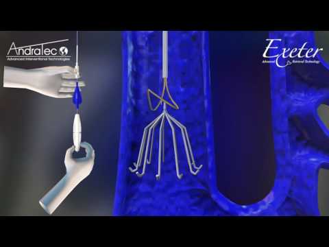 AndraTec Exeter Snare Vena Cava Filter Retrieval