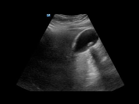 Gallbladder, Cholecystitis Ultrasound: 7/2020
