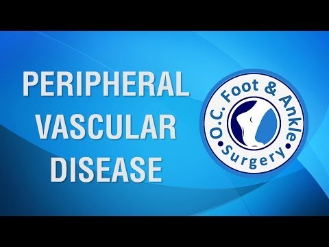 Peripheral Vascular Disease Treatment by Dr Matt Ahmadi at Orange County Foot and Ankle