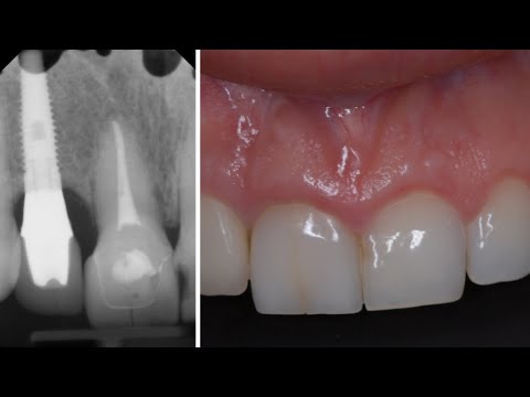 UNCUT! Immediate Tooth Replacement | Dr Sascha A Jovanovic | BLX Implant|Socket Xenog
