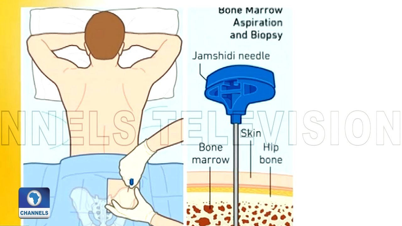 Bone Marrow Transplant For Sickle Cell Disease
