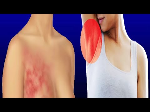 Can Itchy Armpits Be A Sign Of Cancer?