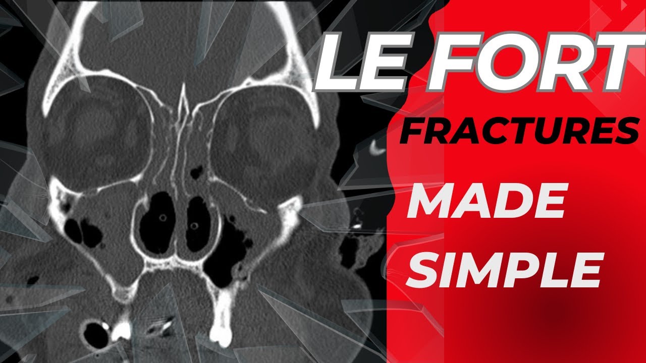 Le Fort fractures on CT