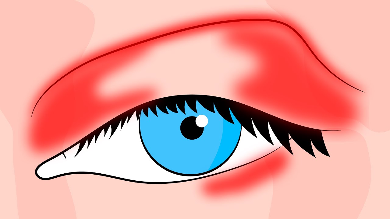 Fix Swollen Eyelids FAST with This 3 minute Natural Hack