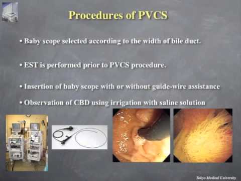 Diagnostic Peroral Video Cholangioscopy Is an Accurate Diagnostic Tool for Patients with...