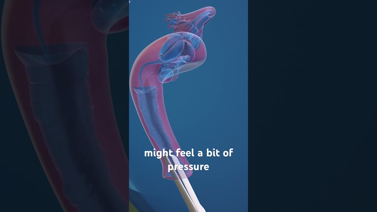 Pap test procedure  3d animation #pape #paps #prophy #pato #patt #padesky #philivey #ptep #tpaf