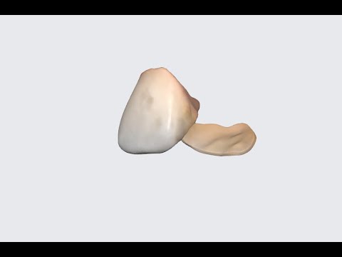 Digital/virtual extraction of a tooth and Maryland bridge design using Medit Design