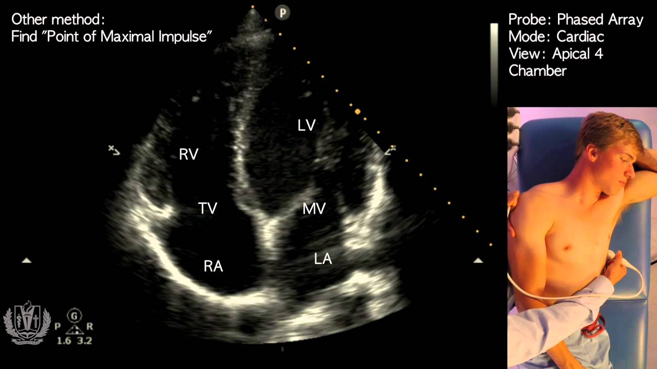 Apical 4 Chamber View on Transthoracic Echocardiography (Cardiac Ultrasound)