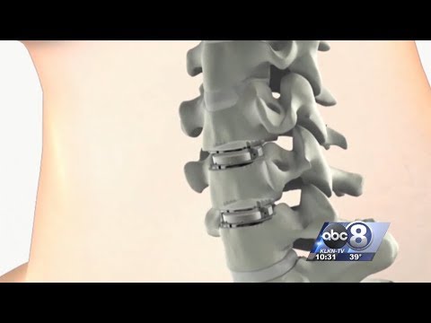 Second Sunday Bryan Health Report: Mobi-C Cervical Disc