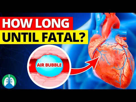 How Long for an Air Embolism to Become Fatal?