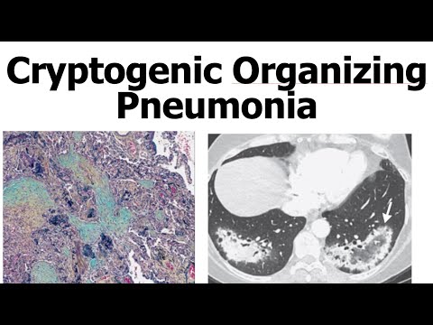 Cryptogenic Organizing Pneumonia (COP)