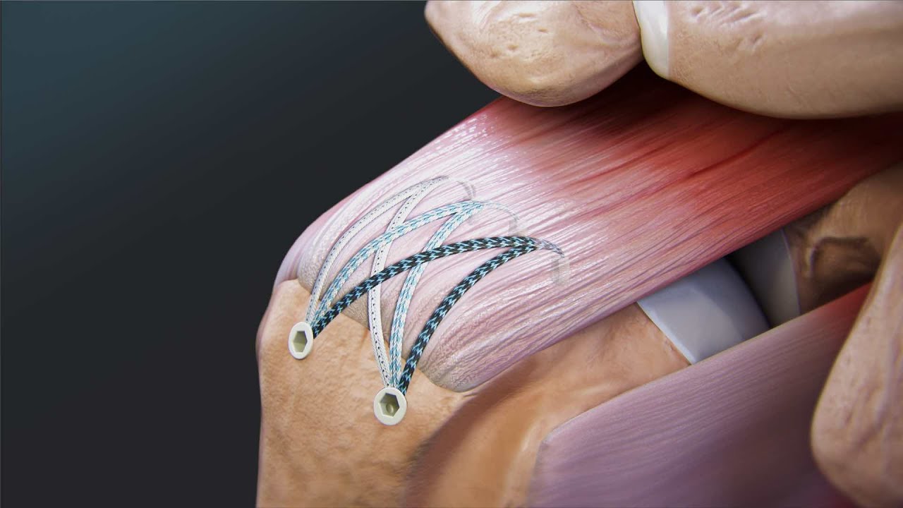 FiberTak® SpeedBridge™ Rotator Cuff Repair