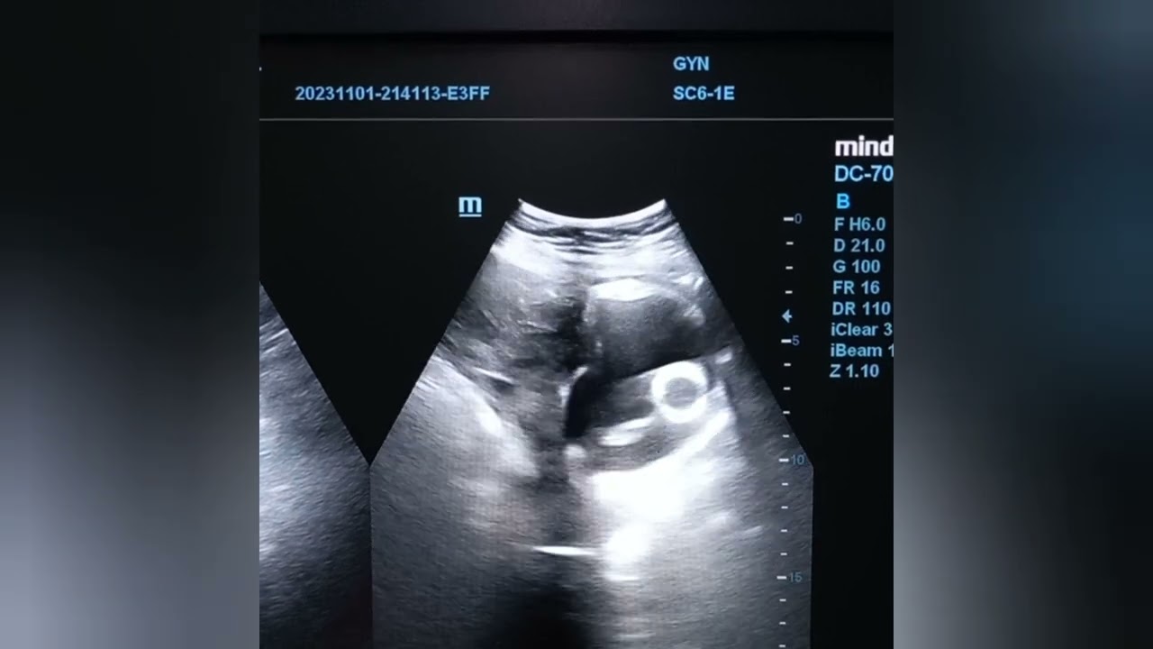 Rupture ectopic pregnancy