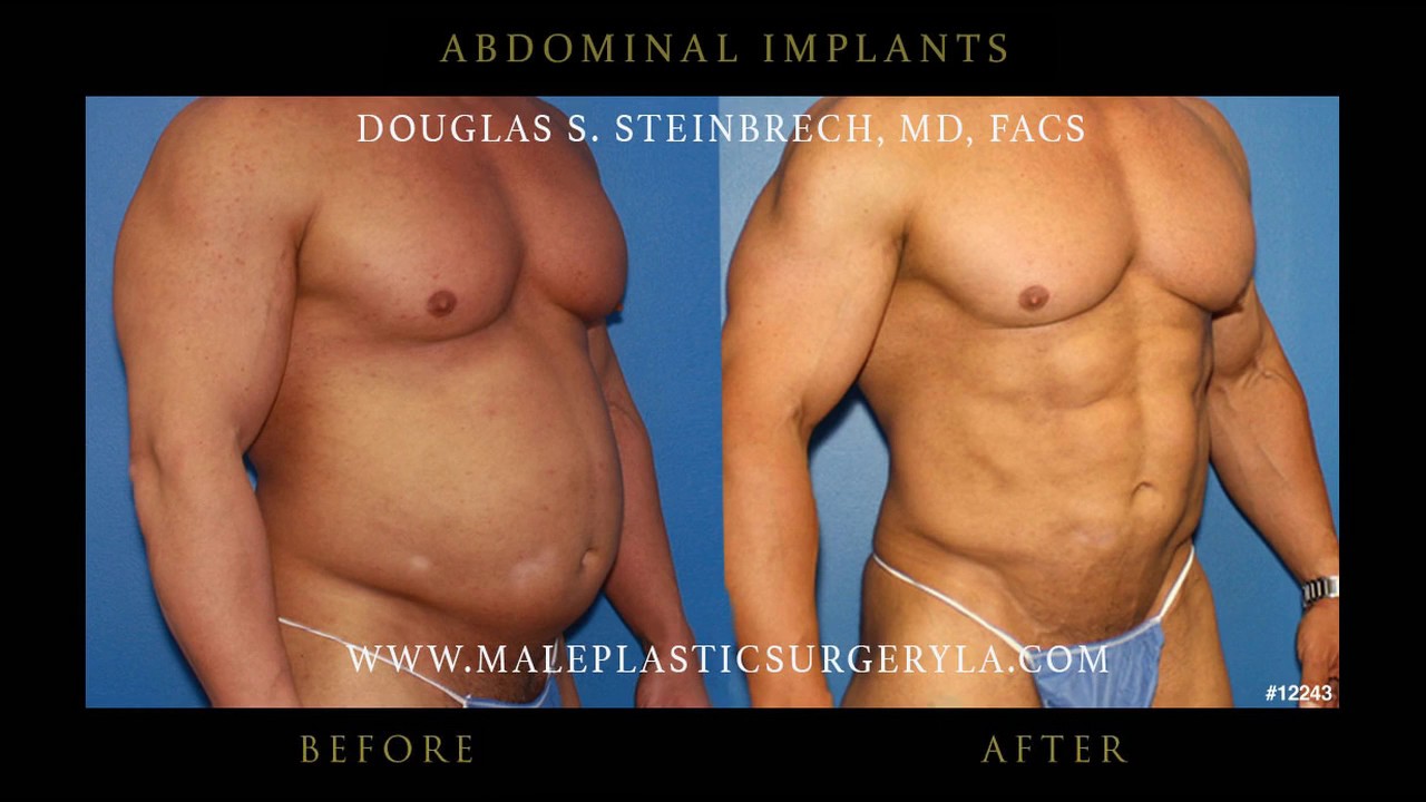 Abs Implants Before and After Photos of Los Angeles Patients