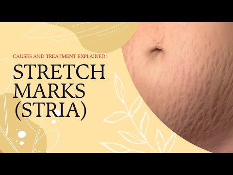 Stretch Marks (Stria) - CAUSES AND TREATMENT EXPLAINED - STRATUM DISTENSAE