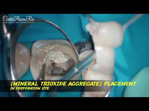 MINERAL trioxide aggregate (MTA) placement in perforation site endodontic treatment