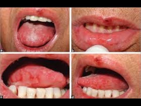 Measuring Tolerance Dose of the #Methotrexate for Induction of Oral #Mucositis in Dark a #Gourti Rat