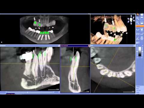 27 mental foramen