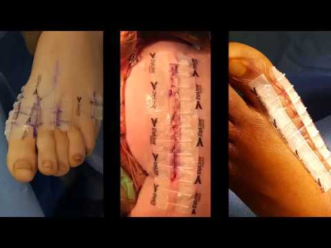 Zip use in foot and ankle surgery