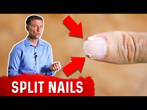 What's Lacking With Split Nails