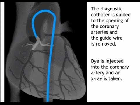 Percutaneous transluminal coronary angioplasty (PTCA)