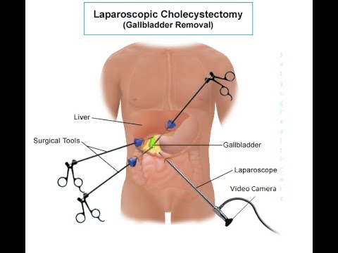 Get safe & hassle-free gallbladder removal surgery by renowned gastro surgeons.