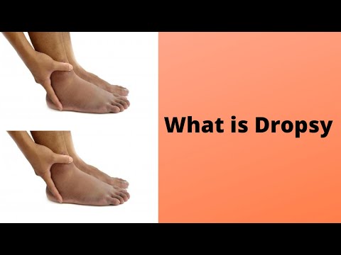 What is Dropsy