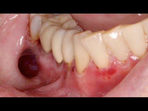 ASTHMA INHALER Side Effect Responsible For Strange LESIONS on Gums?! 🧐