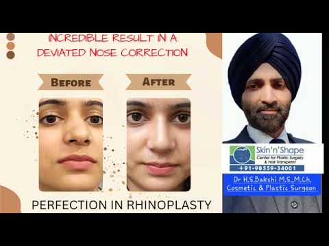 Rhinoplasty in India - Dr. HS Bakshi - Skin-n-Shape, Chandigarh | Best Plastic Surgeon in Chandigarh