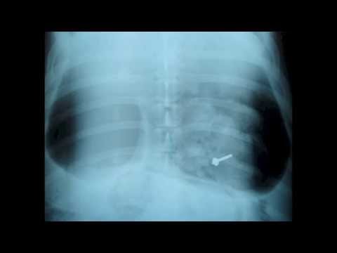 New drug-delivery capsule may replace injections