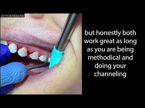 Curette vs Probe Style with an Ultrasonic