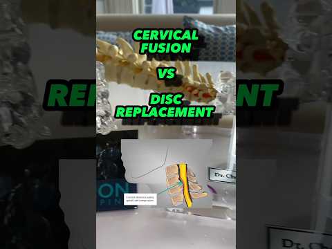 Cervical FUSION vs โREPLACEMENTโ - both are honestly GREAT for the right INDICATORS โ๏ธ๐