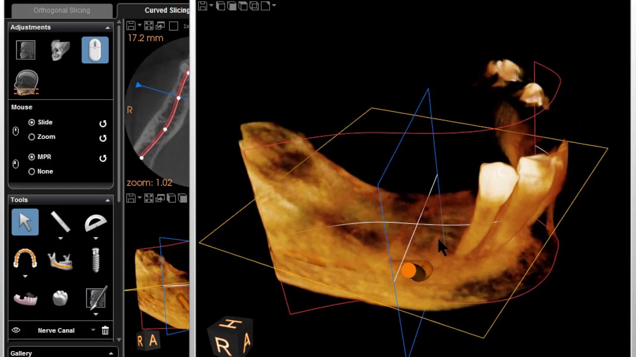 cs 3d imaging software for implant planning