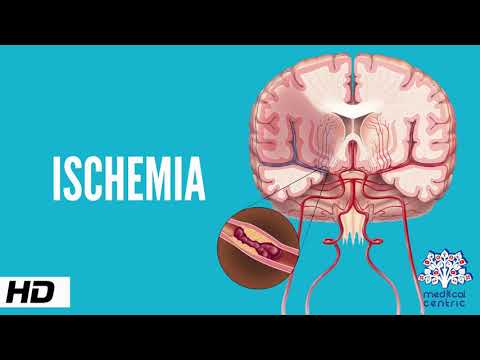Ischemia, Causes, Signs and Symptoms, Diagnosis and Treatment.