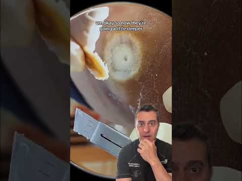 Satisfying Foot WART Removal!
