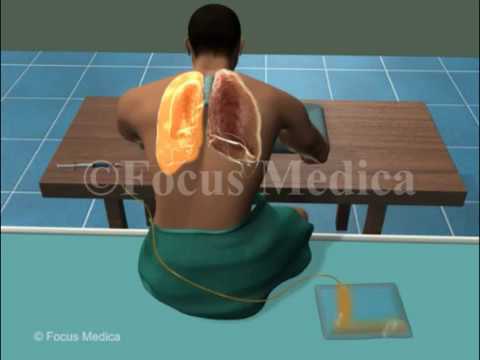 Drainage of pleural effusion - Lungs