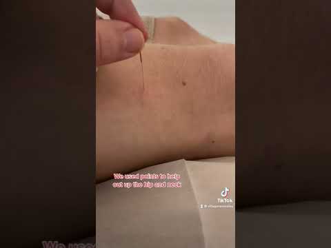 Acupuncture treatment
