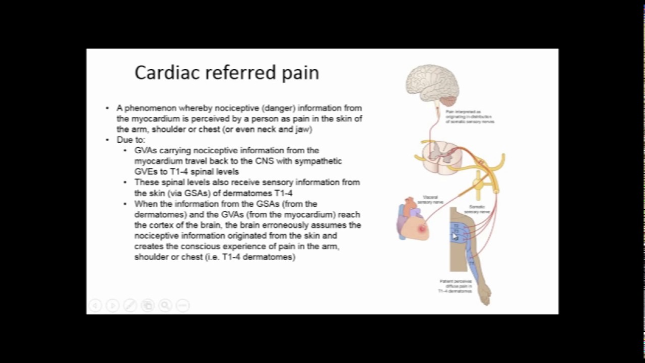 Understanding Cardiac Referred Pain: A Closer Look at Its Mechanisms ...