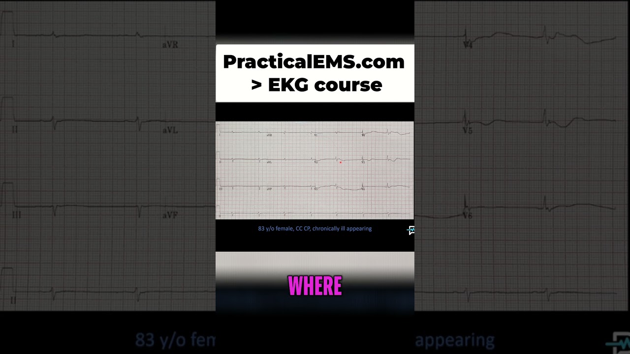ARVC Explained: Delta and Epsilon Waves in Arrhythmia