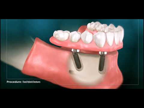 Teeth in a Day - Mandibular Arch