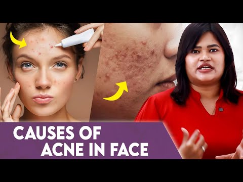Face-ல இங்க acne வந்தா இதான் காரணம்! Dr Radha Subramaniyan | Causes of acne in face