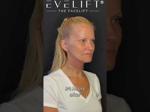 EVE Lift™ 24 Hour Results | Eden Plastic Surgery: Dr. Ali Charafeddine, MD