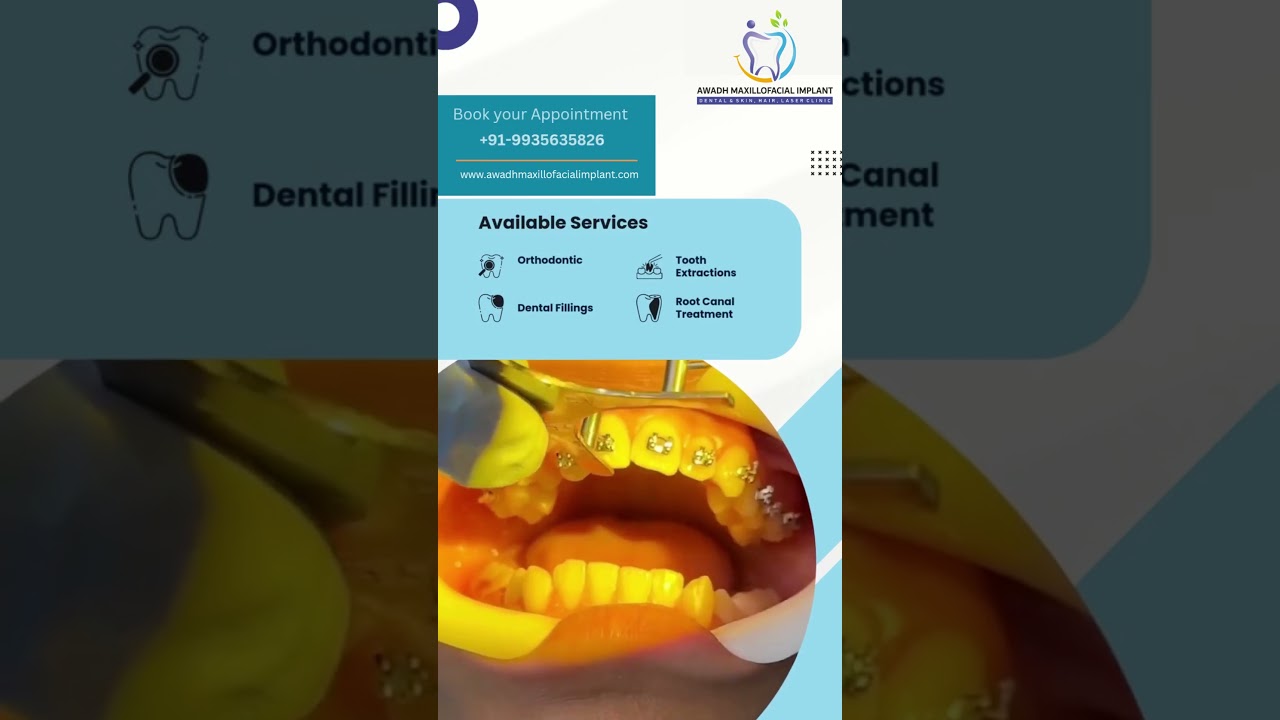 Transforming Smiles, One Bracket at a Time #smiledesigndental #dentist #dentalcare