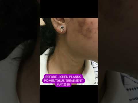 Lichen Planus Pigmentosus Treatment | before & After | Dermatologist in chandigarh | Mohali