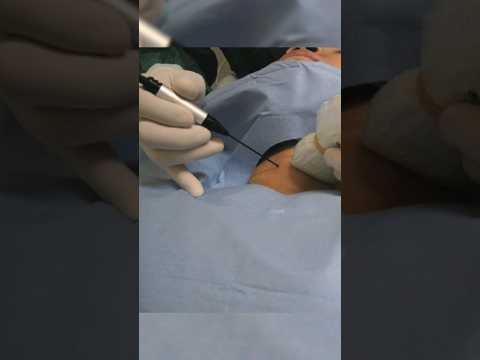 Thyroid nodule treatment without surgery | With a small needle - Scarless | Dr. Gaurav Gangwani